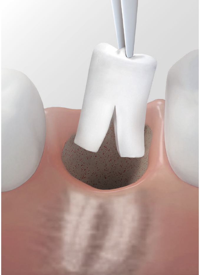 HYADENT BG – hialuronskābes želeja mutes dobuma regenerācijai - ZOBO